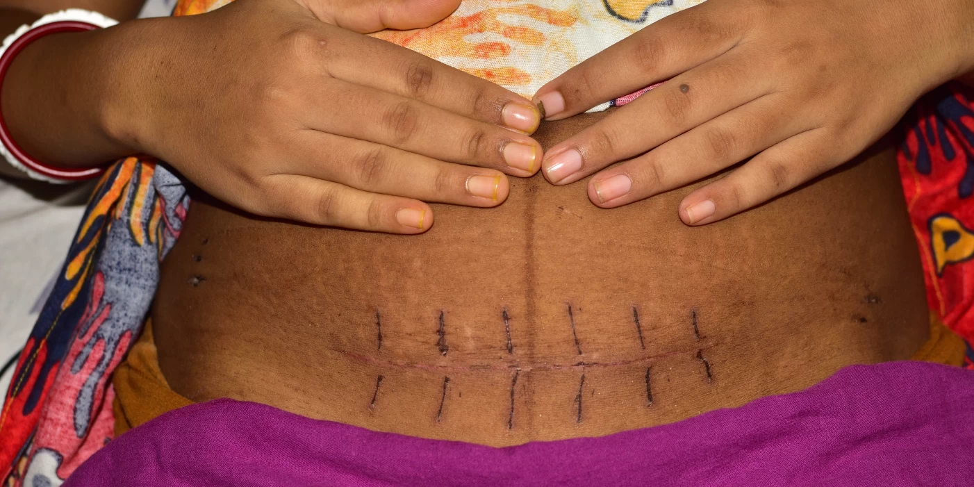 Indications for a Caesarean Section: When and Why It’s Necessary ...